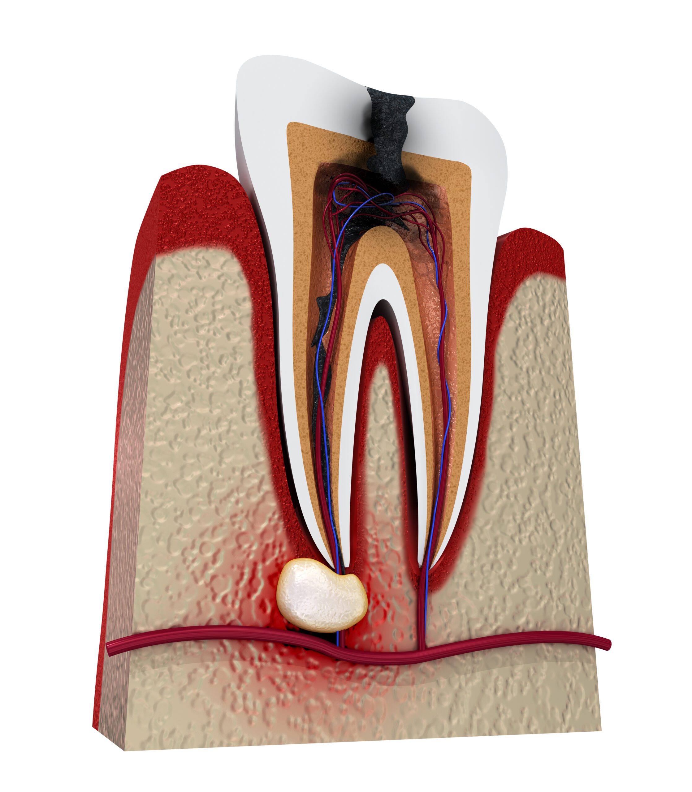 Understanding Gum Abscesses: A Comprehensive Guide - Patient Empowered ...