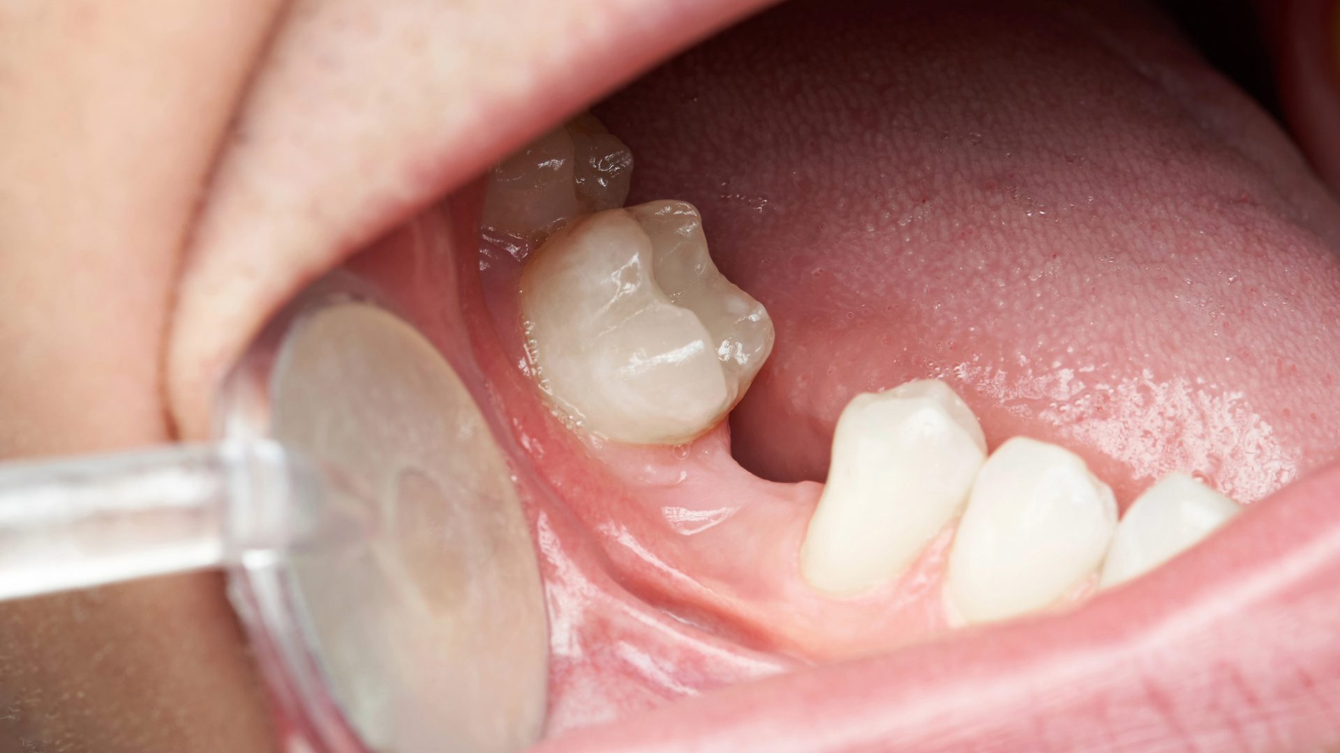 So You're Getting a Tooth Pulled? Your Week-by-Week Recovery Guide ...